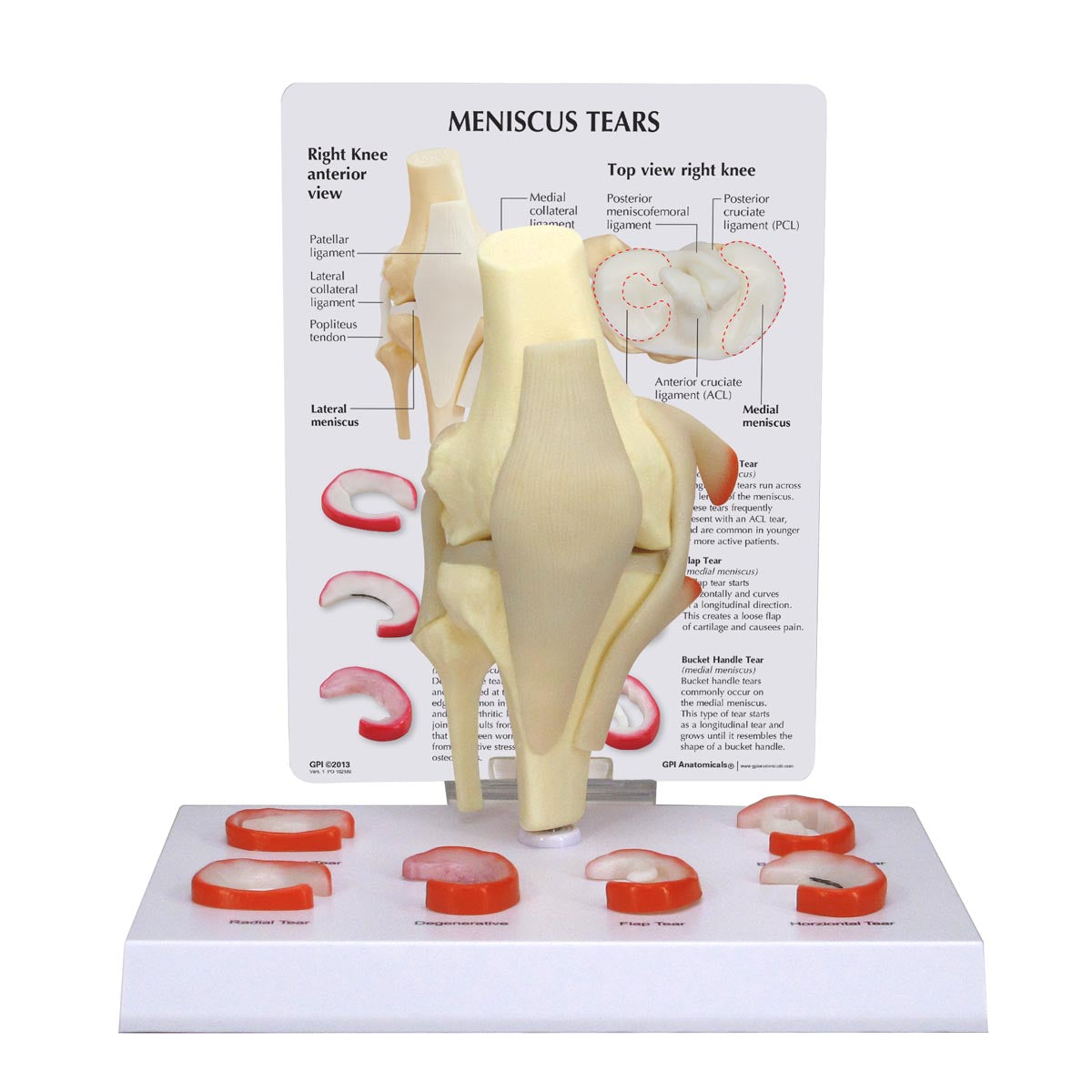 Model de genunchi menisc cu 6 rupturi de menisc – ANATOMIKA