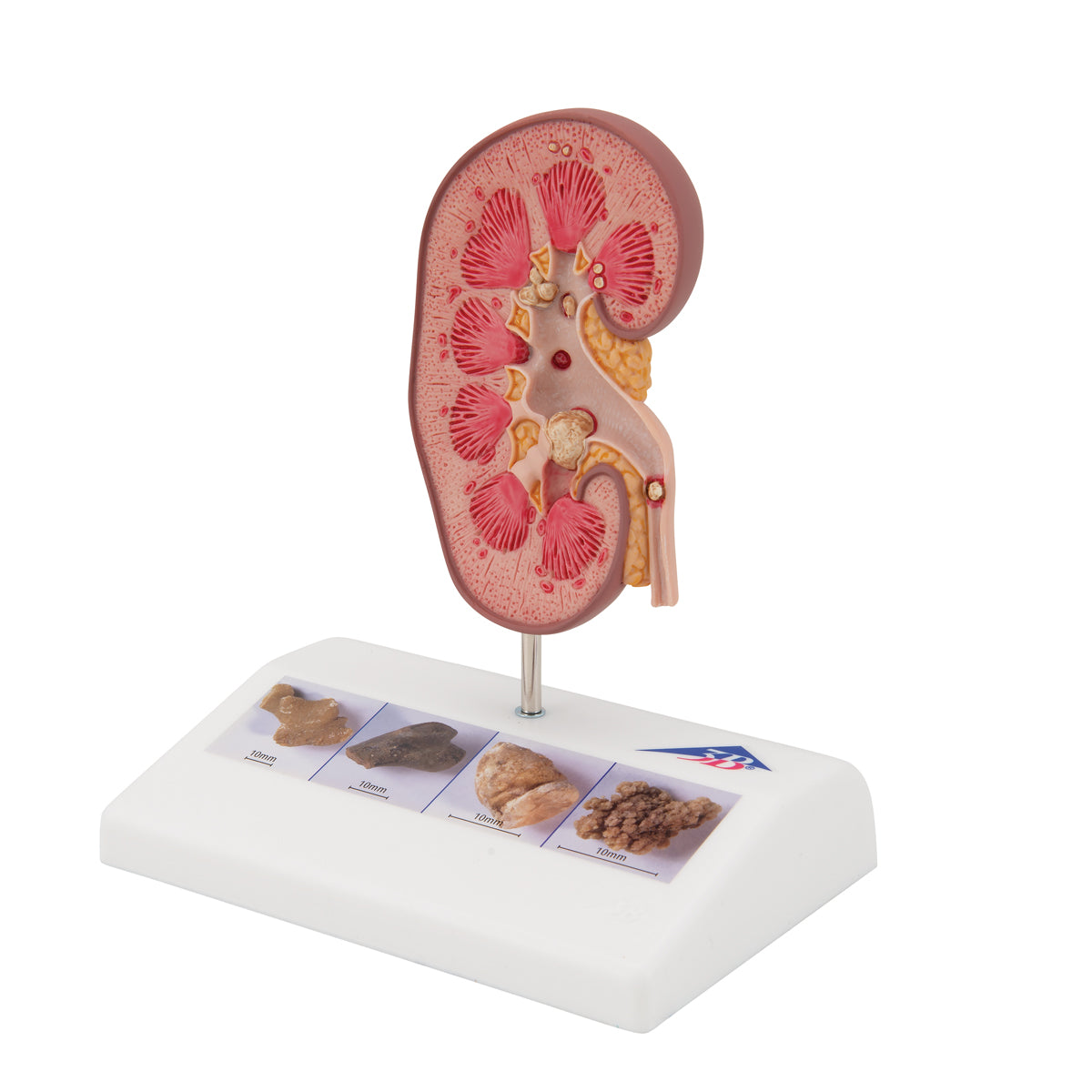Model pietre la rinichi - 3B Smart Anatomy – ANATOMIKA